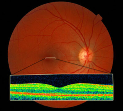 Oct 3D Retinal Scan – Early and Edmonds Opticians